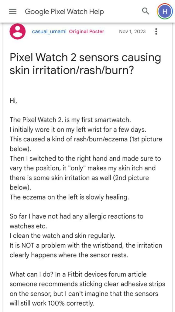 Google Pixel Watch 2 causing skin irritation for some users